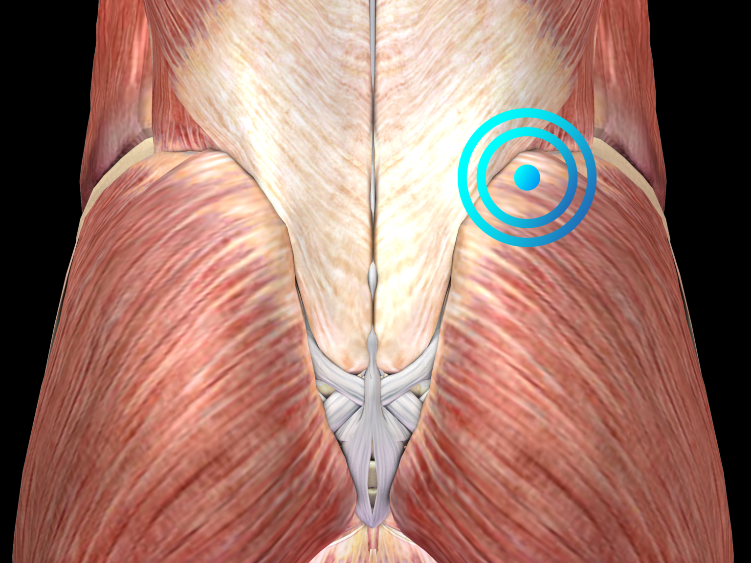 Myofascial Trigger Points Ems Dolorclast®