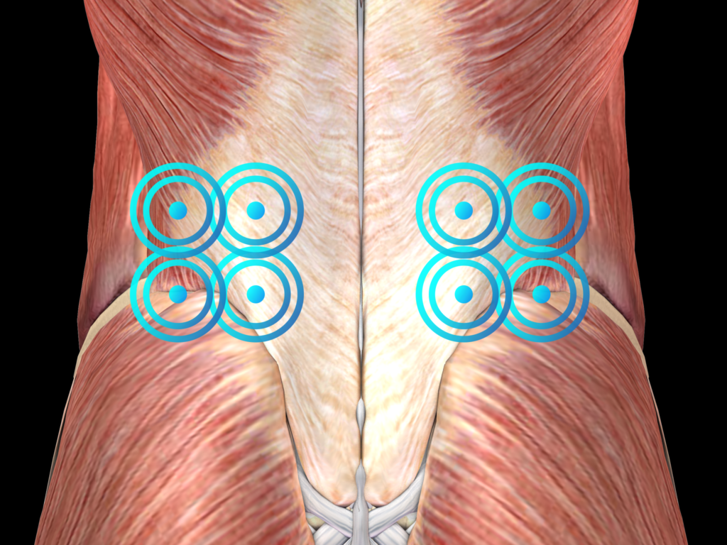 Lower Back Pain – EMS DolorClast®