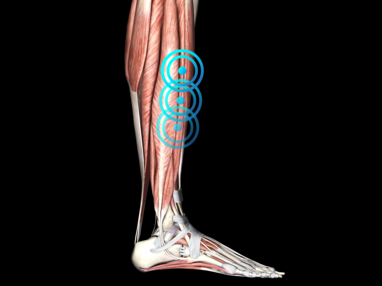 Medial Tibial Stress Syndrome – EMS DolorClast®