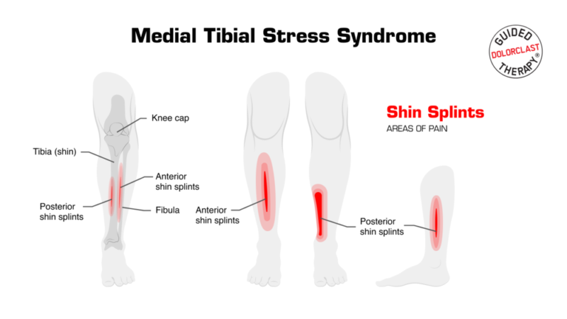 Shock Wave Therapy as a Treatment for Medial Tibial Stress Syndrome ...